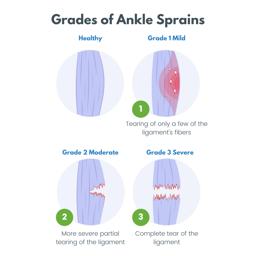 Sprains, Strains, and Tears, Oh My! | Chiropractic Care | Pittsburgh ...